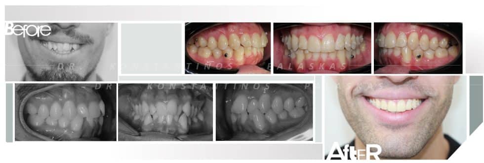 Maloclusión Clase III: Características, Mordida Invertida y Tratamientos